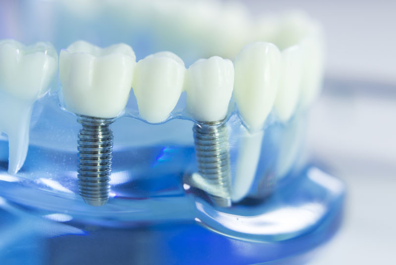 What Every Patient Should Know About Dental Implants | Lane Oral ...